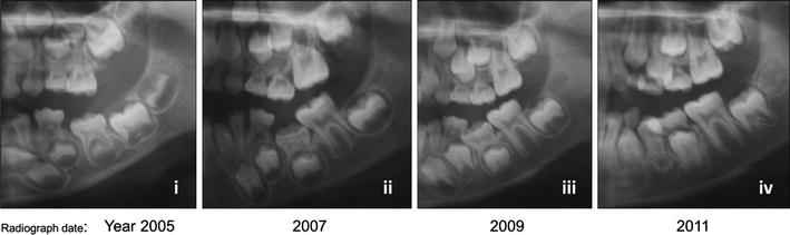 Primary failure of eruption or severe infra-occlusion: a misdiagnosis ...