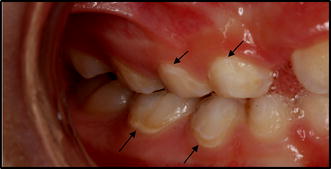 Molar incisor hypomineralisation (MIH) training manual for clinical ...