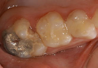 The Würzburg MIH concept: the MIH treatment need index (MIH TNI ...