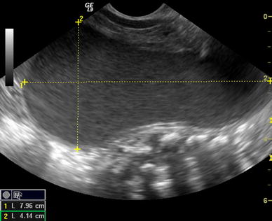 Imperforate hymen causing congenital hydrometrocolpos | SpringerLink