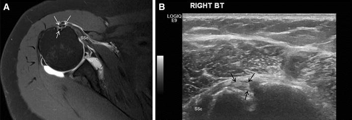 Ultrasound appearance and dynamic evaluation of variant long head of ...