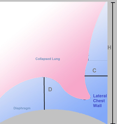 Validation of equations for pleural effusion volume estimation by ...