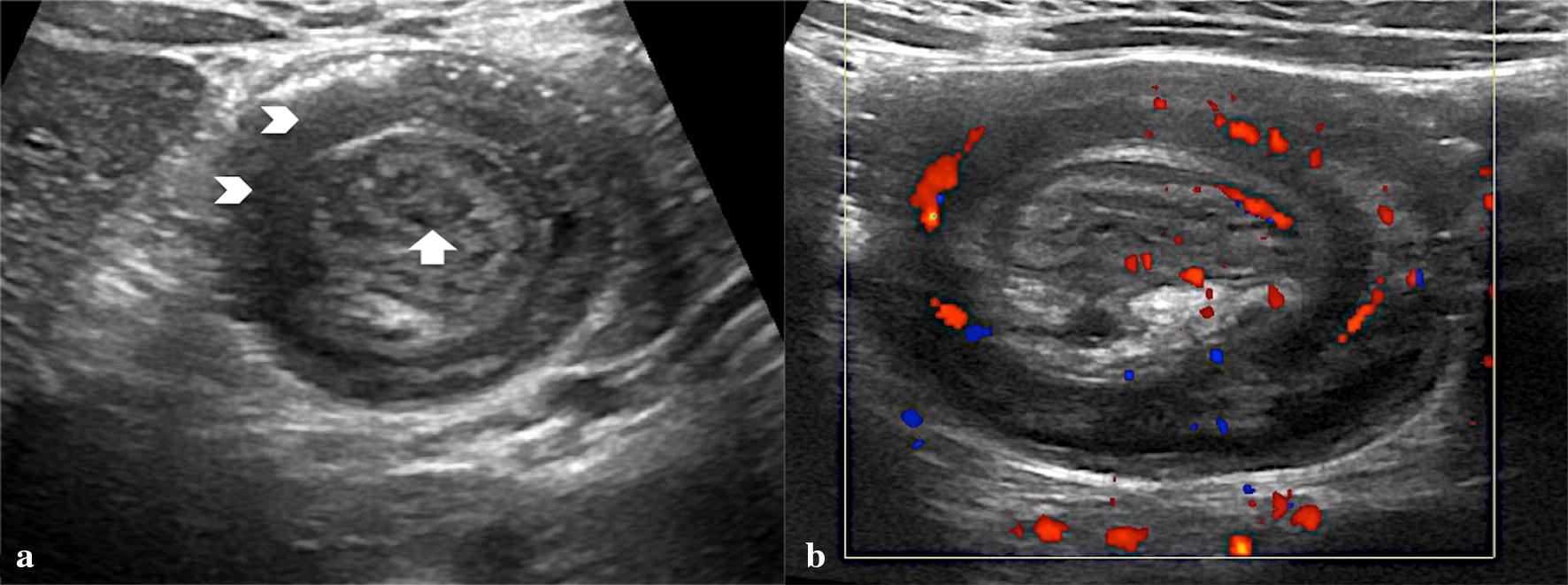 The pediatric gastrointestinal tract: ultrasound findings in acute ...