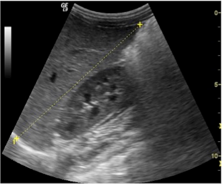 Paediatric liver ultrasound: a pictorial essay | SpringerLink