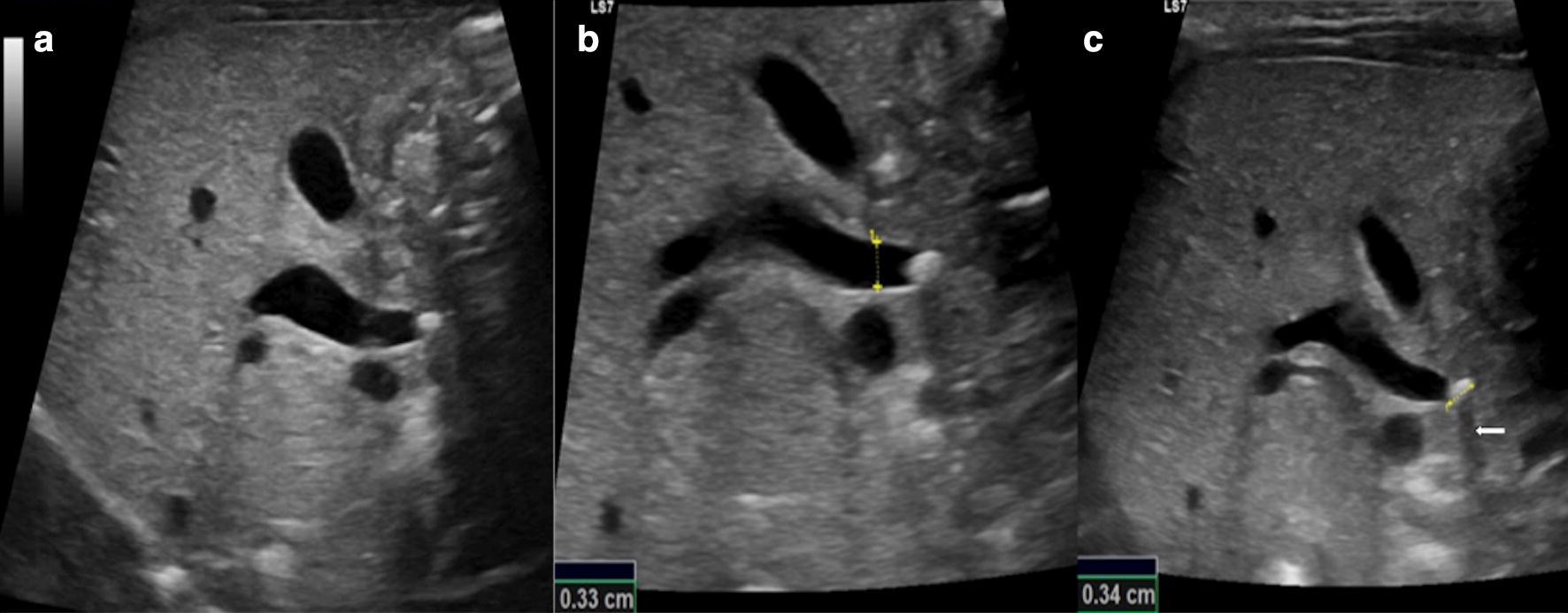 Ultrasound findings in paediatric cholestasis: how to image the patient ...