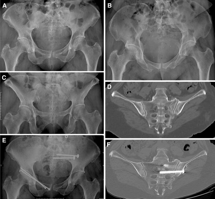 Fragility fractures of the pelvis: treatment and preliminary results ...