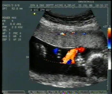 Intrauterine Transfusion | SpringerLink