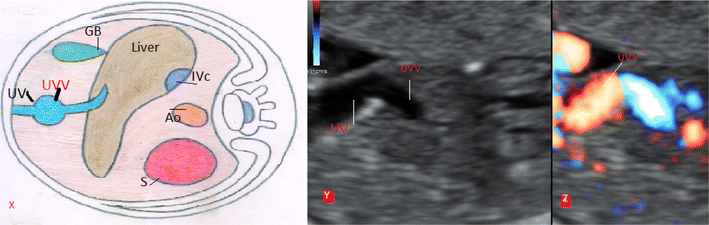 Sonographic Evaluation of Umbilical Vein | SpringerLink