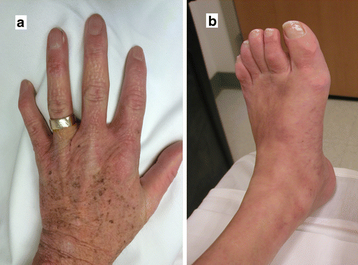 Scleroderma Mimickers | SpringerLink