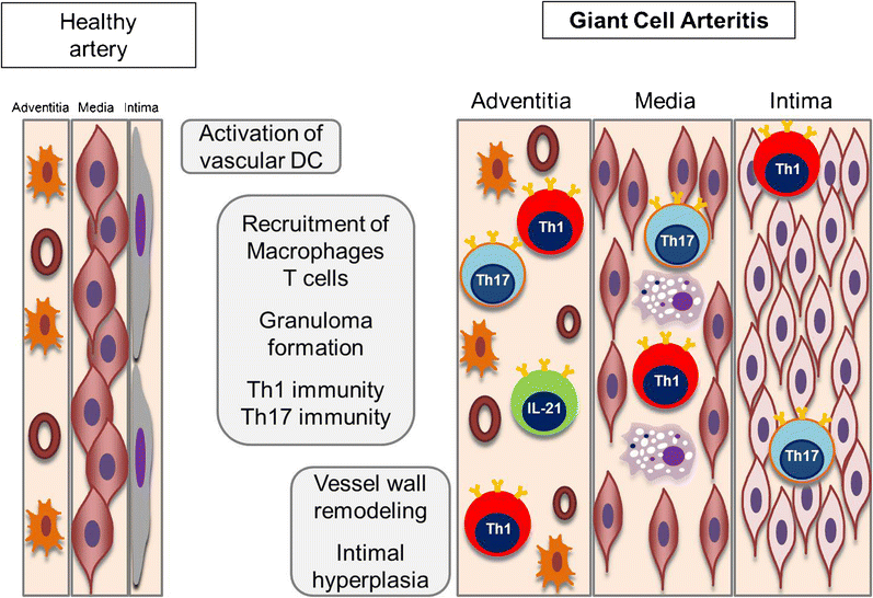 Giant Cell Arteritis: From Pathogenesis to Therapeutic Management ...