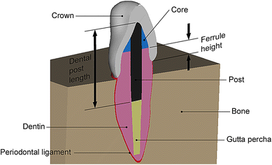 Effect of Ferrule Height and Post Length on Mechanical Stress and ...