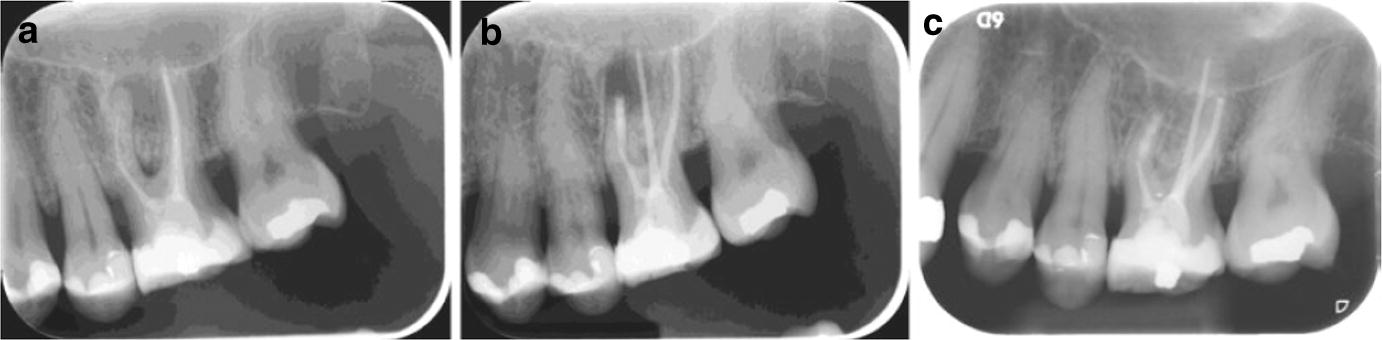 Surgical endodontic retreatment | SpringerLink