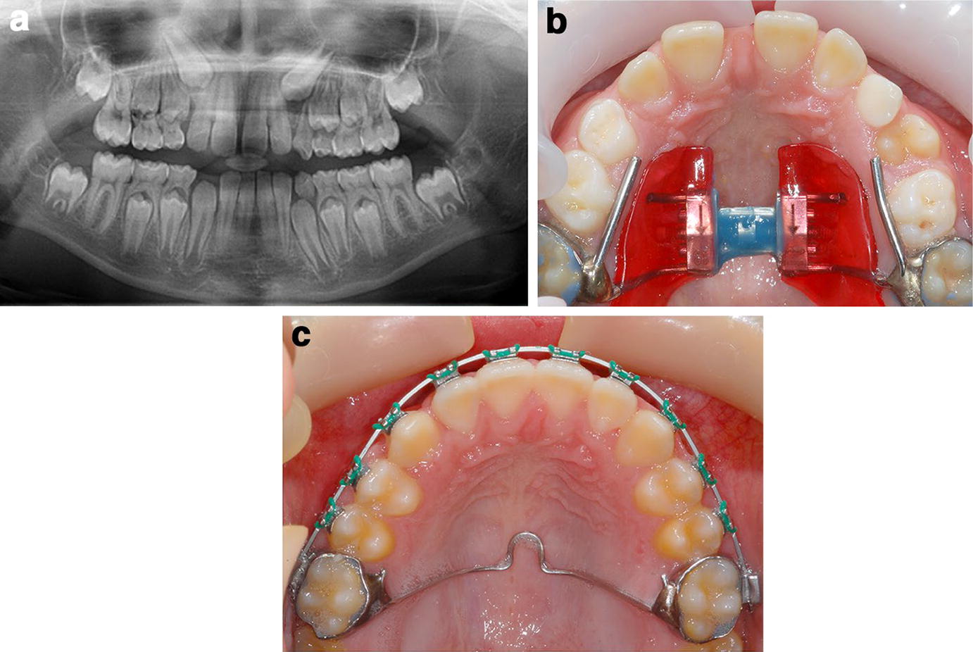 Management of the palatally displaced canine | SpringerLink