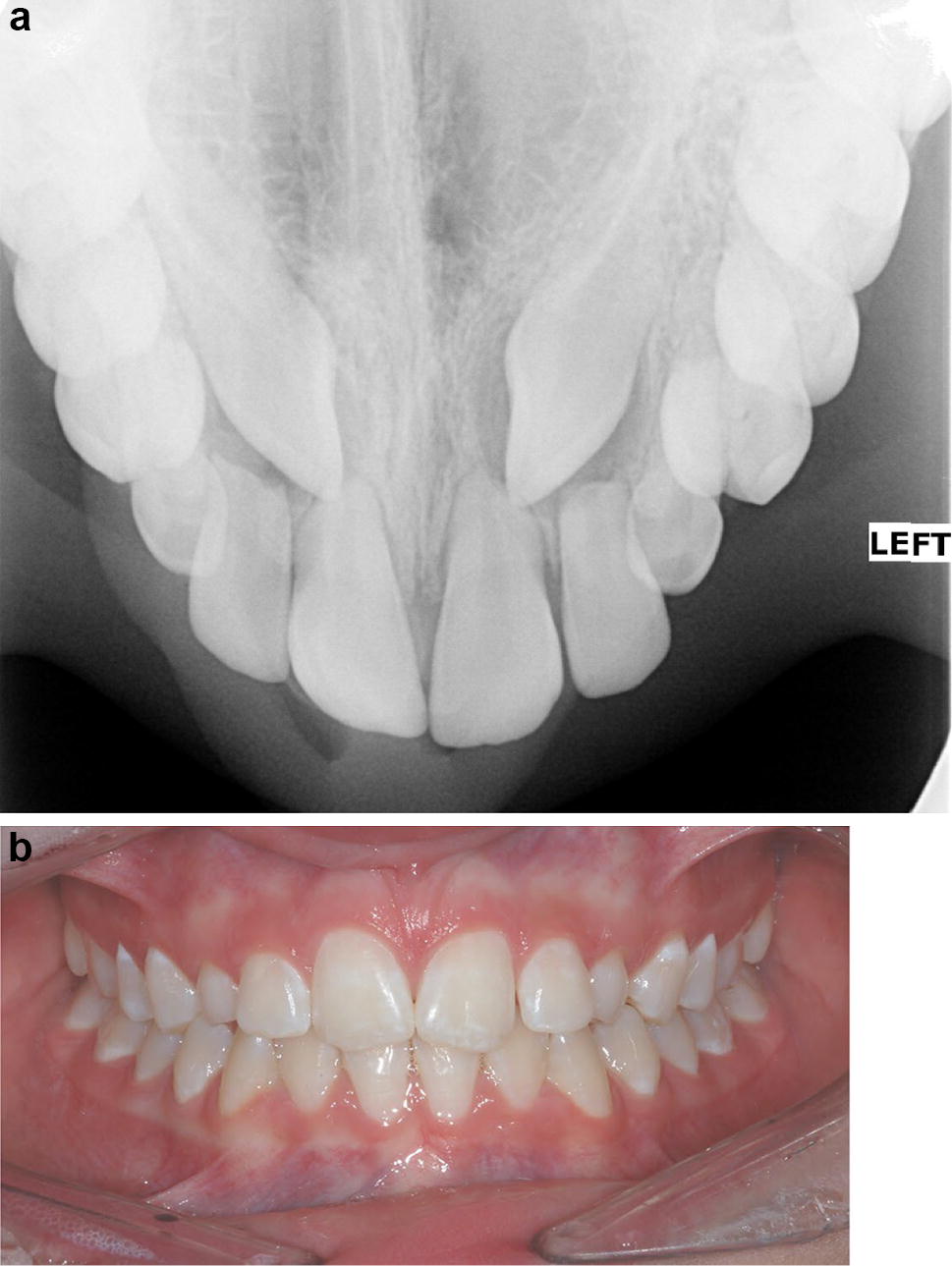 Management of the palatally displaced canine | SpringerLink
