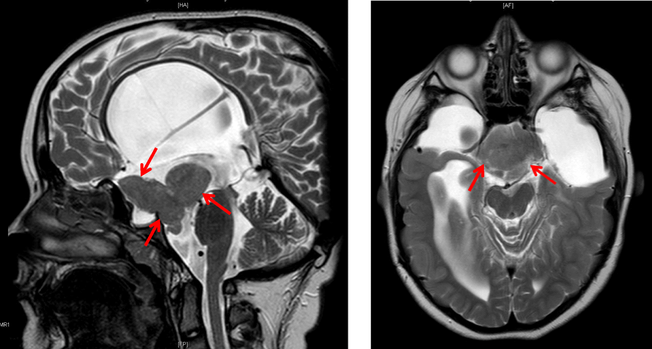 Radiosurgery Techniques in the Treatment of Epilepsy Related to Hypothalamic Hamartomas ...