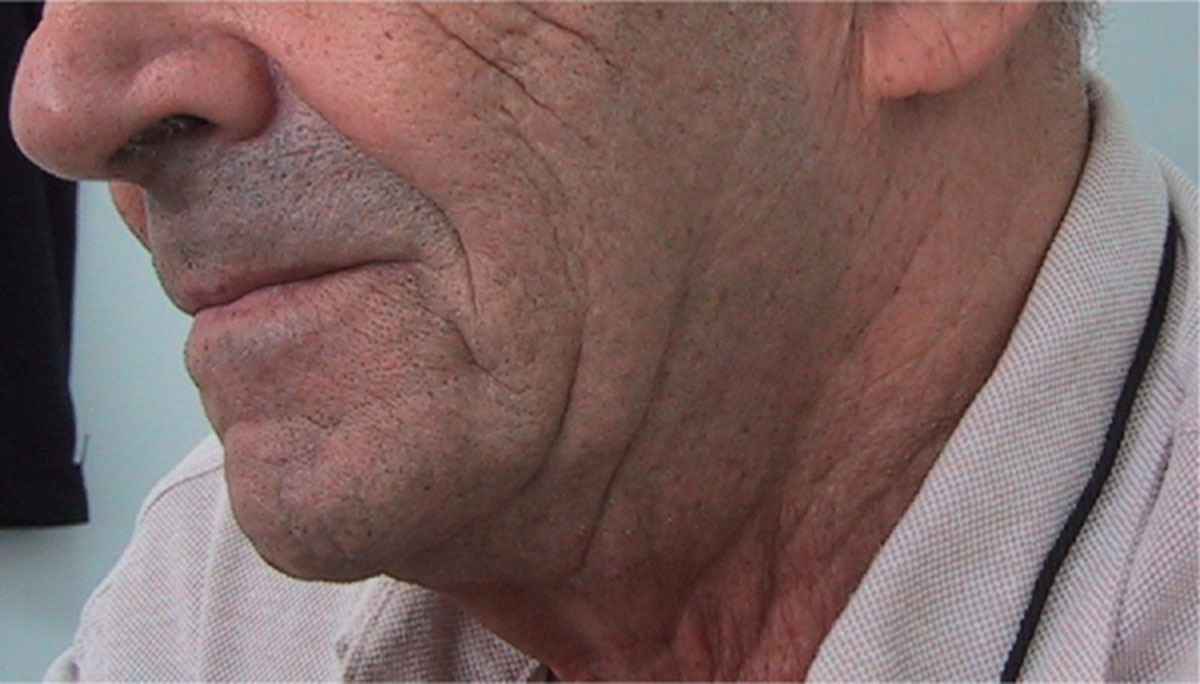 Iodide Mumps | SpringerLink