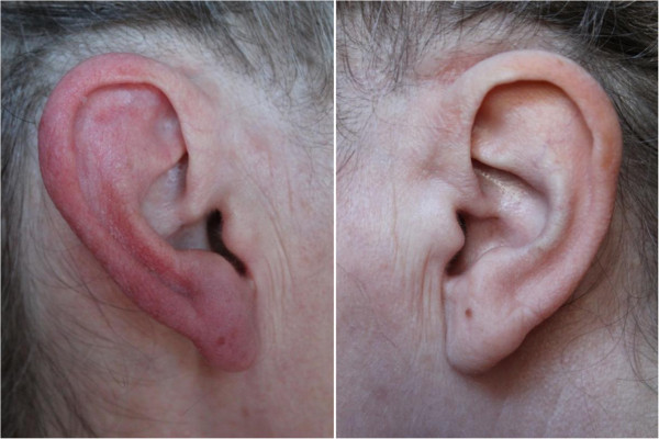 The red ear syndrome | SpringerLink