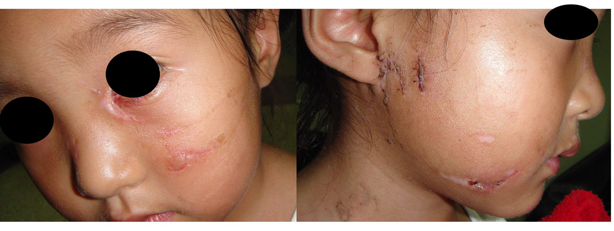 Emergency treatment on facial laceration of dog bite wounds with ...