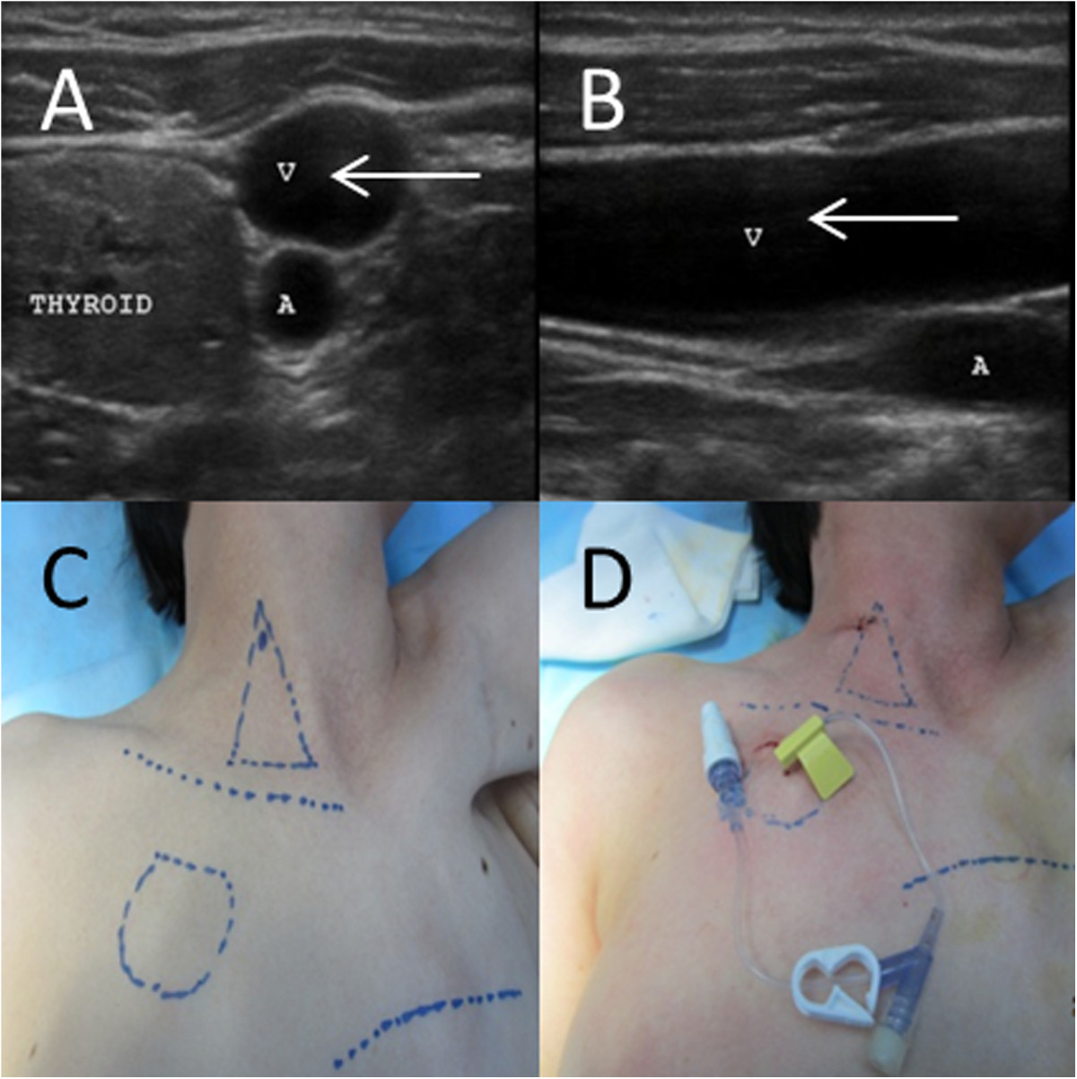 Implanting totally implantable venous access port via the internal ...