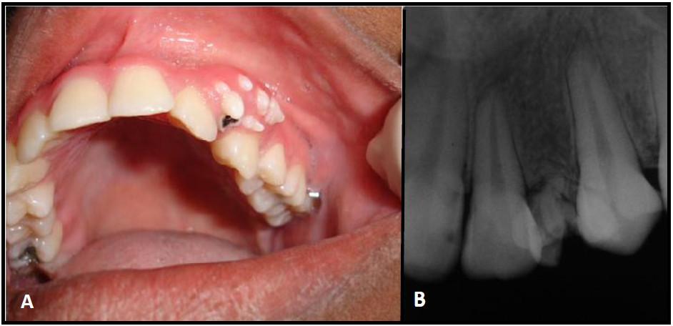 Peripheral compound odontoma erupting in the gingiva | SpringerLink