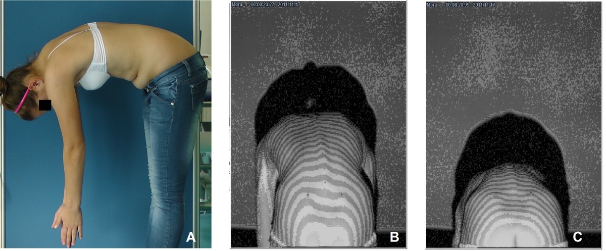 School screening for scoliosis: can surface topography replace ...