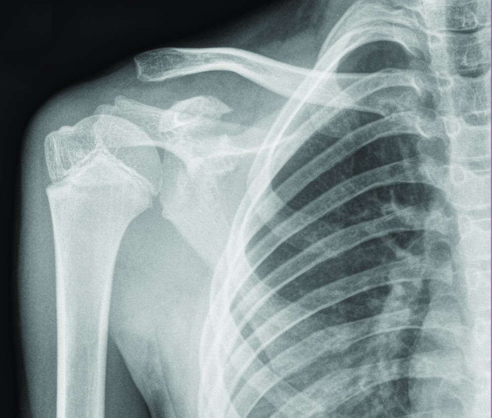 Base of coracoid process fracture with acromioclavicular dislocation in ...