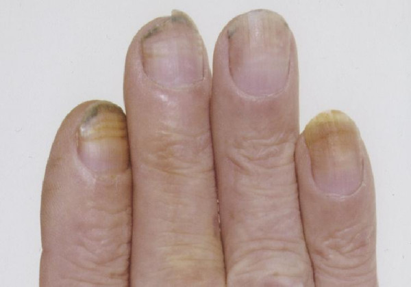 Nail changes secondary to docetaxel chemotherapy : a case report ...