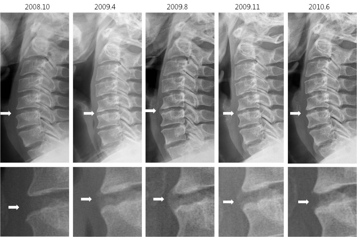 Regression of syndesmophyte after bone marrow transplantation for acute ...