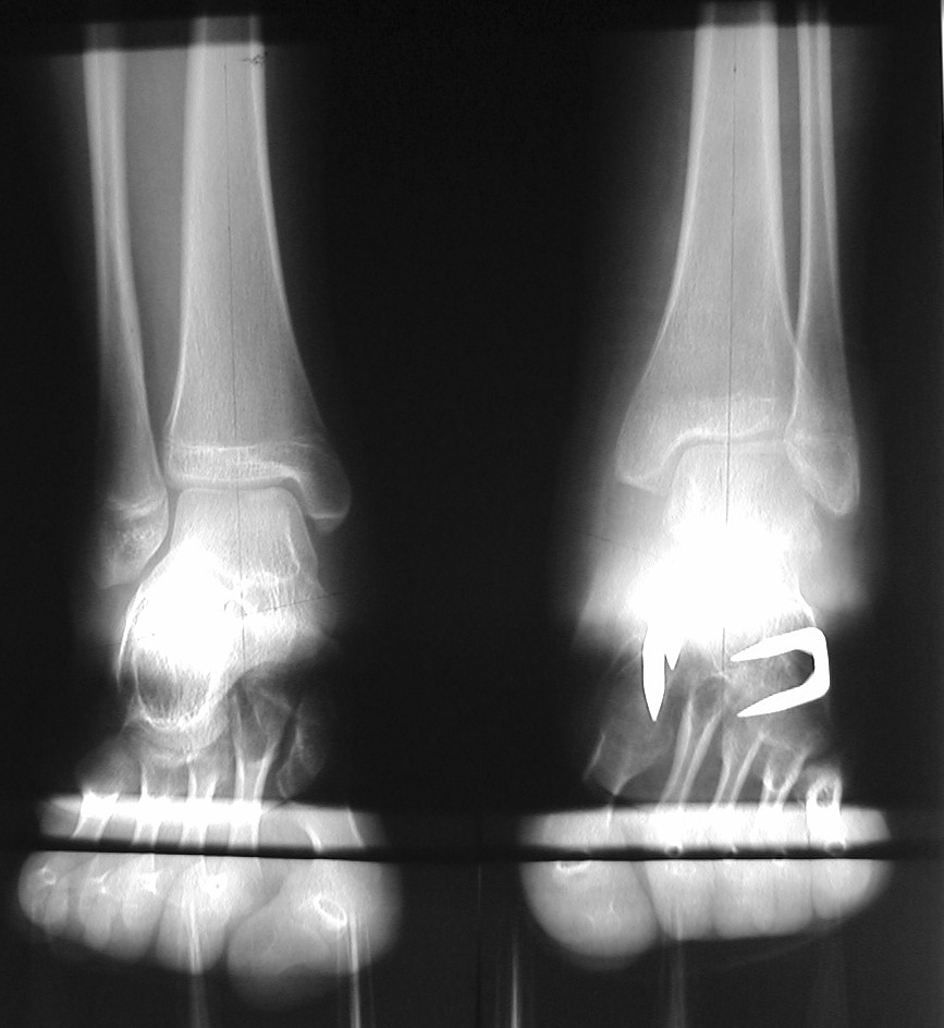 A new radiographic view of the hindfoot | SpringerLink