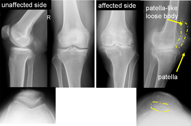 A double patella-like condition secondary to synovial ...
