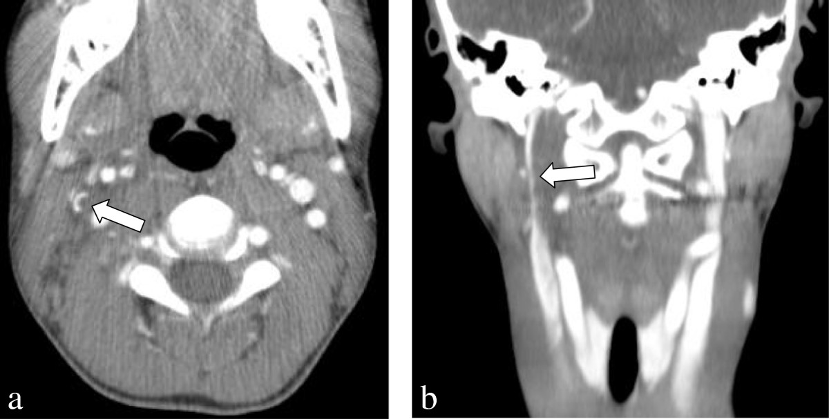 Lemierre’s syndrome | SpringerLink