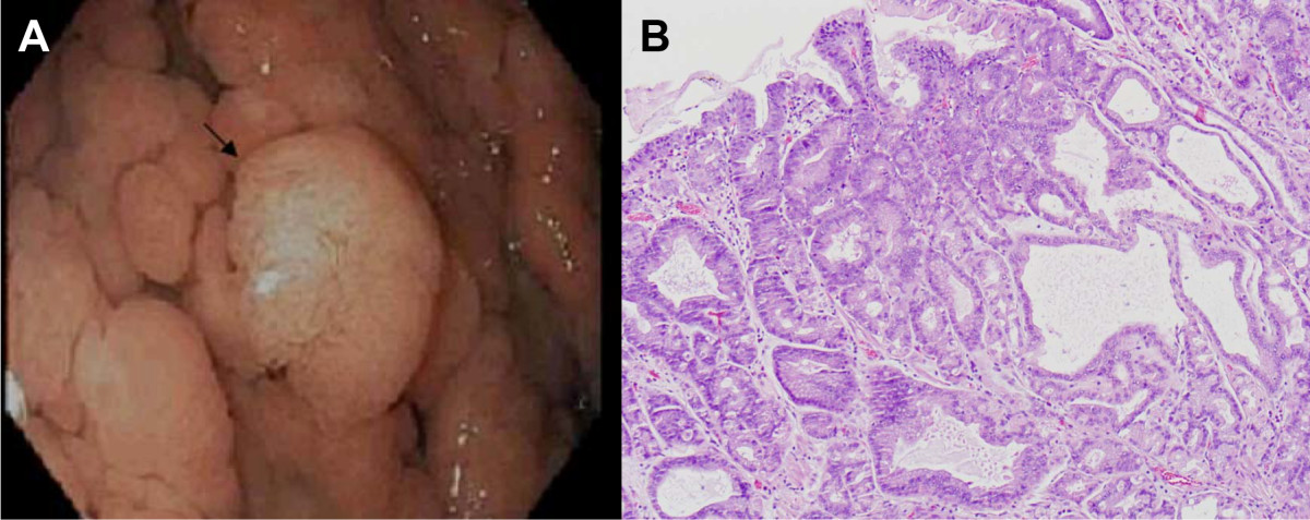 Gastric adenomas in familial adenomatous polyposis are common, but ...