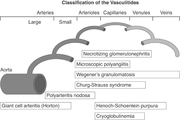 Vasculitis: mechanisms involved and clinical manifestations | SpringerLink
