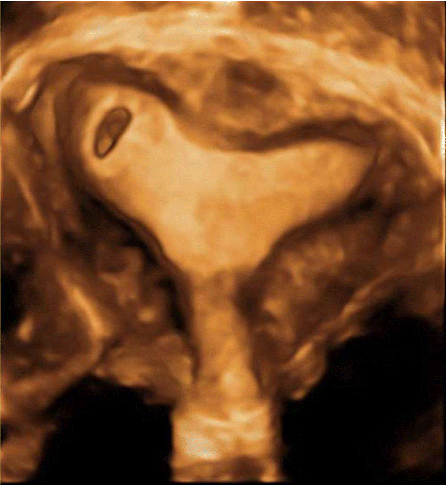 The diagnosis and management of interstitial ectopic pregnancies: a ...