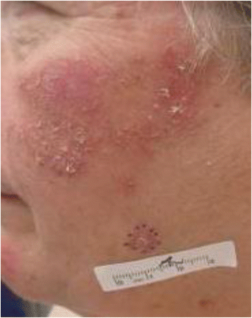 Photosensitive lichenoid skin reaction to capecitabine | SpringerLink