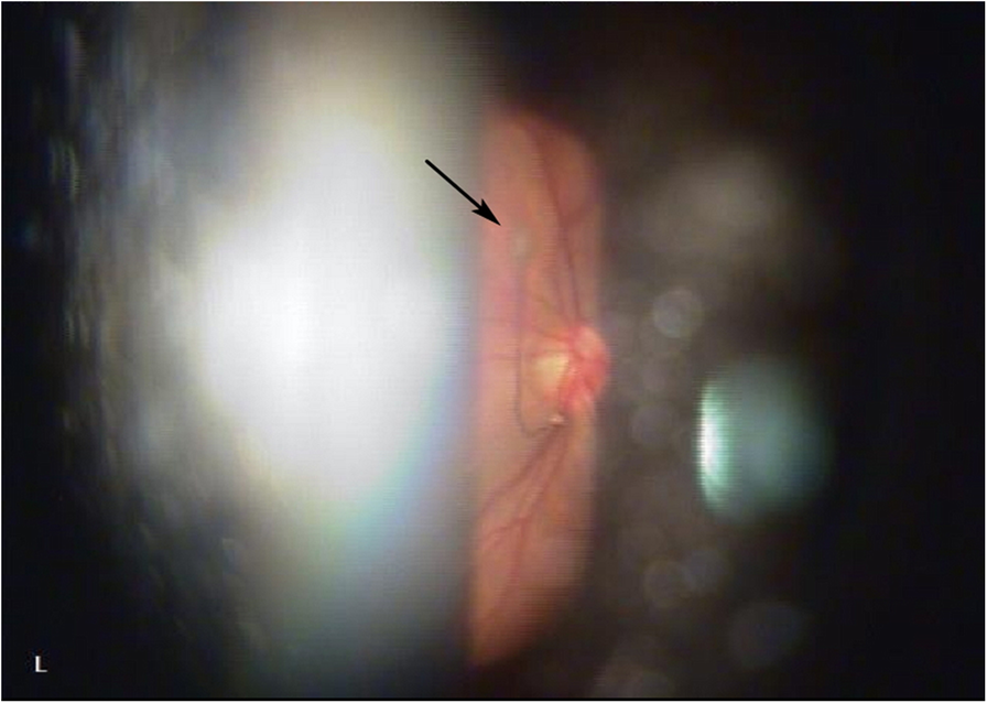 OCT angiography of persistent hyaloid artery: a case report | SpringerLink