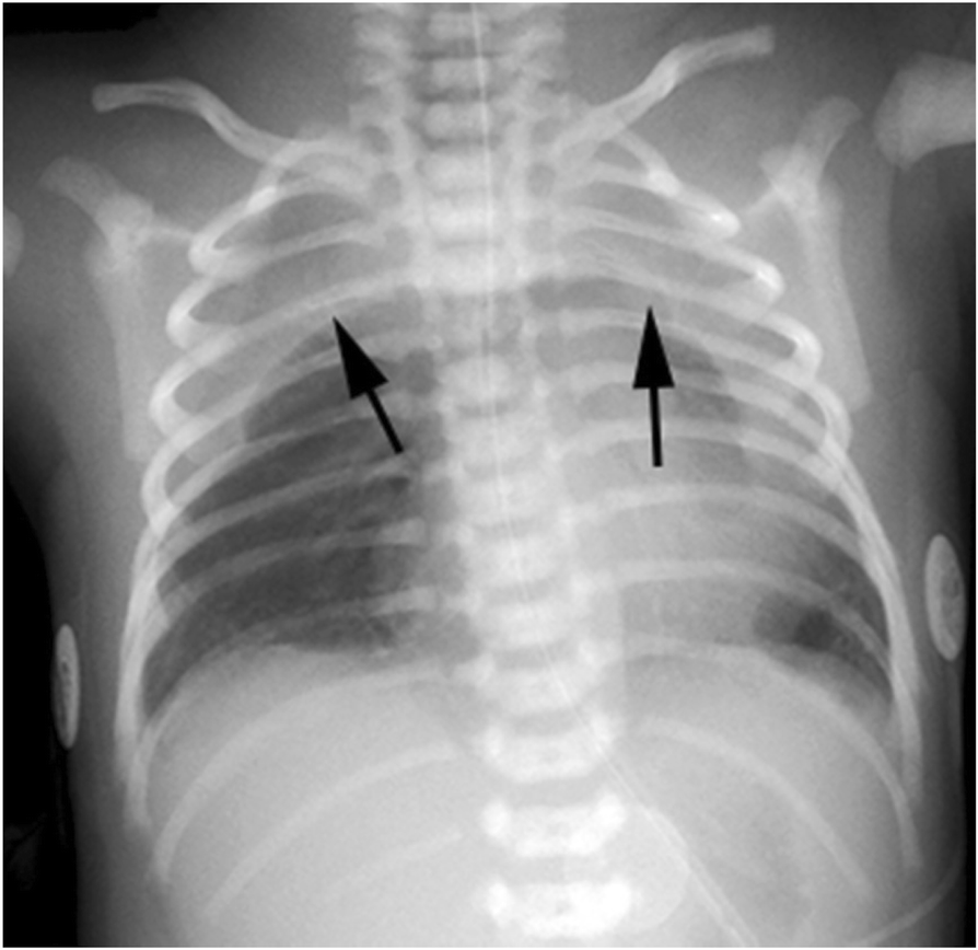 Sail sign in neonatal pneumomediastinum: a case report | SpringerLink