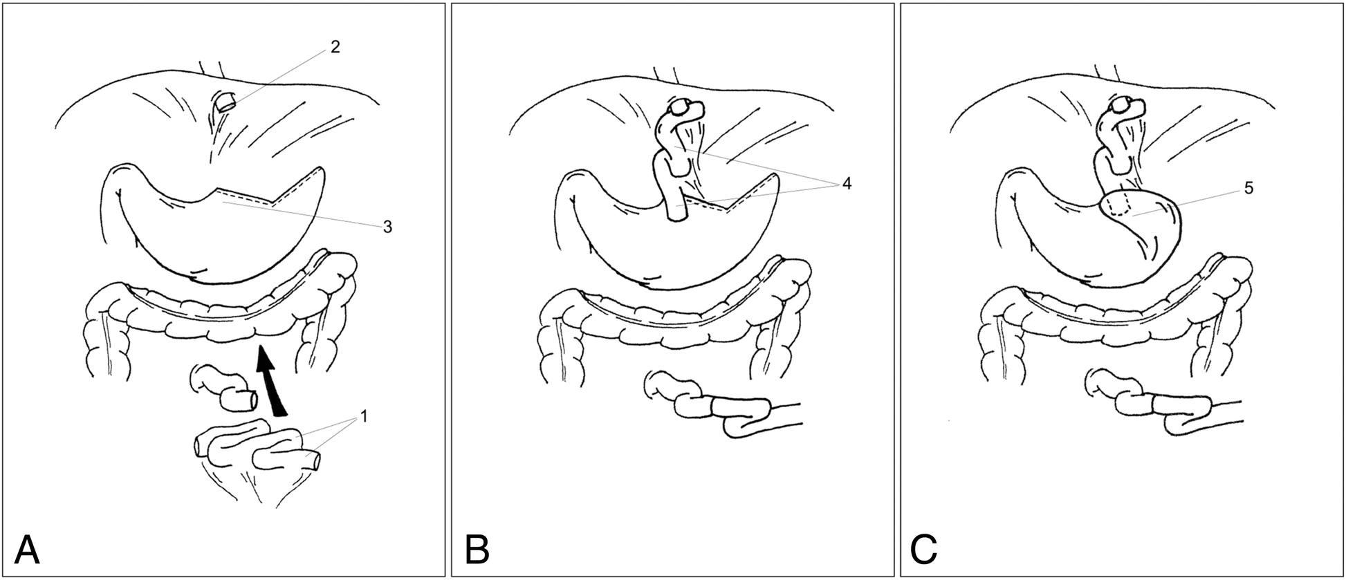 Evaluation of resection of the gastroesophageal junction and jejunal ...
