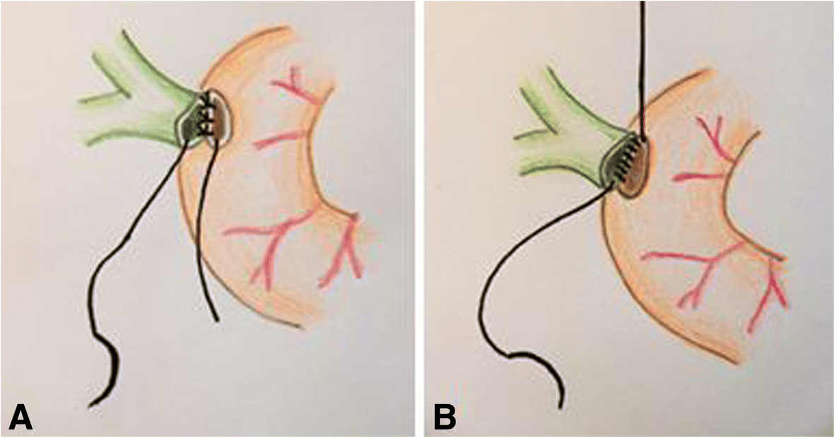 Continuous or interrupted suture technique for hepaticojejunostomy? A ...