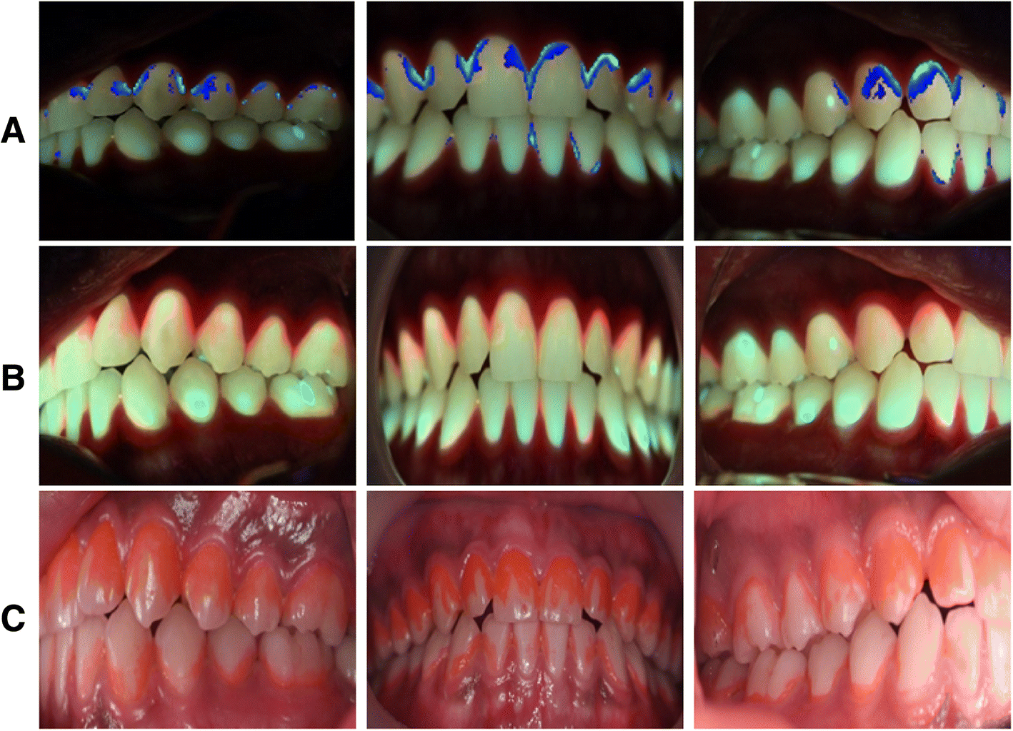 Validity assessment of quantitative light-induced fluorescence-digital ...