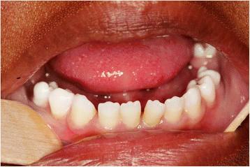 CANDLE SYNDROME: Orofacial manifestations and dental implications ...