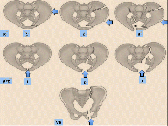 Pelvic trauma: WSES classification and guidelines | SpringerLink