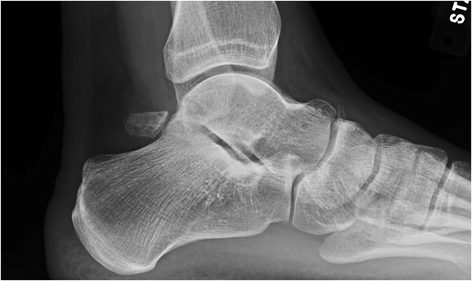 Ankle impingement | SpringerLink