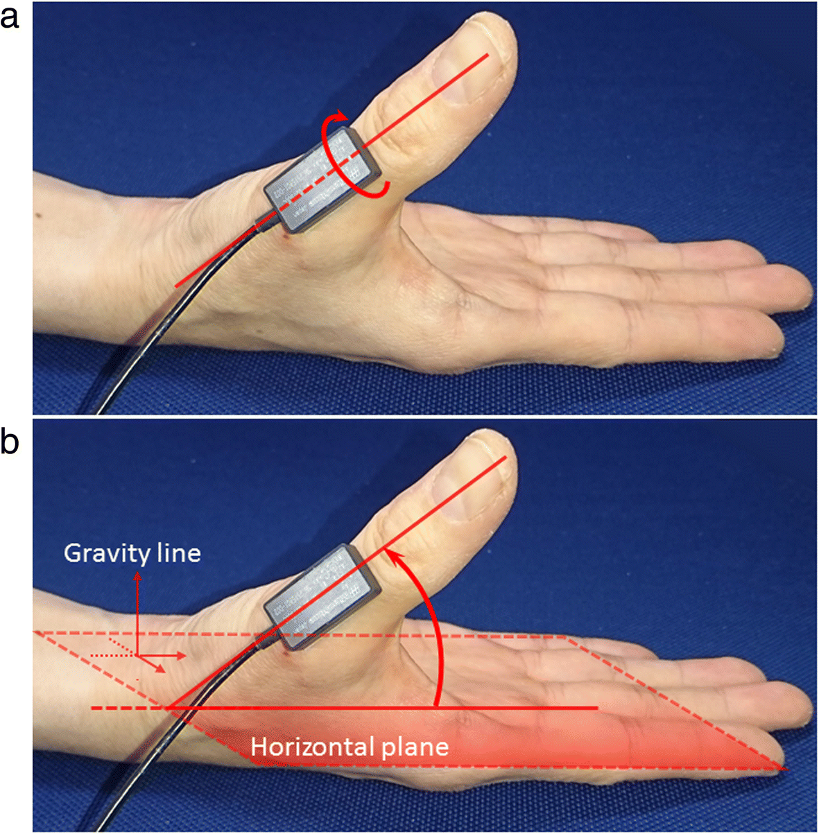 A new method of measuring the thumb pronation and palmar abduction ...