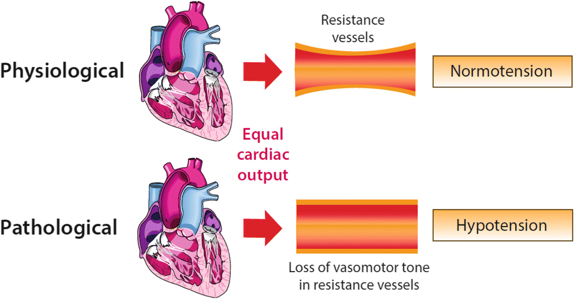 Definitions and pathophysiology of vasoplegic shock | SpringerLink