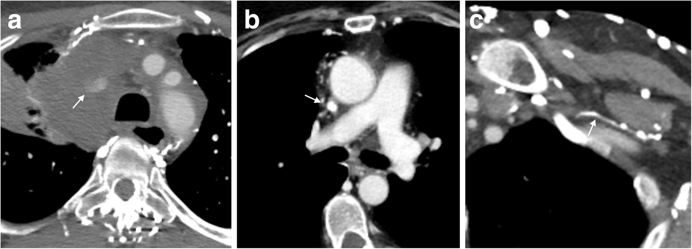Blood finds a way: pictorial review of thoracic collateral vessels ...