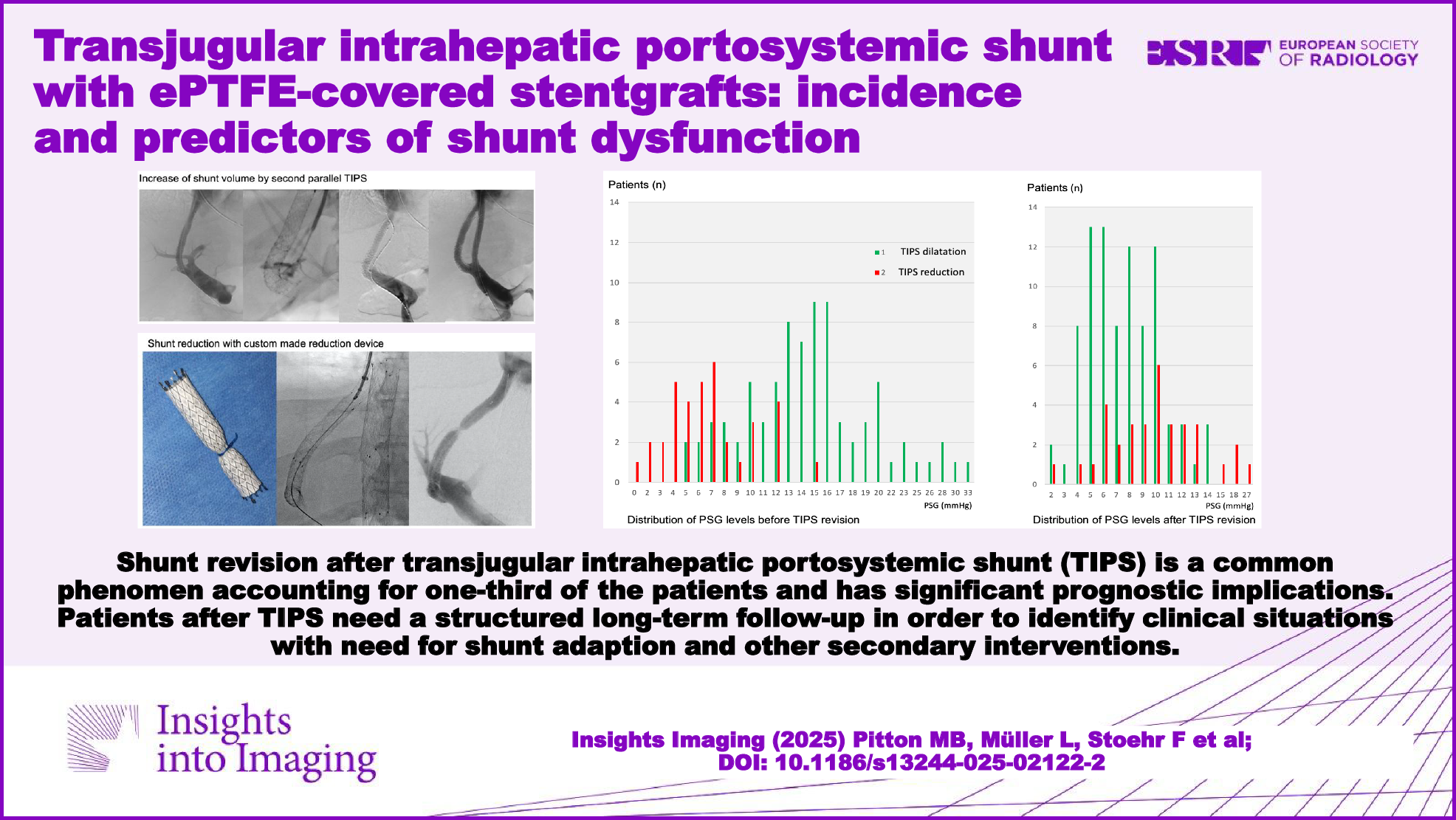 Transjugular intrahepatic portosystemic shunt with ePTFE-covered ...