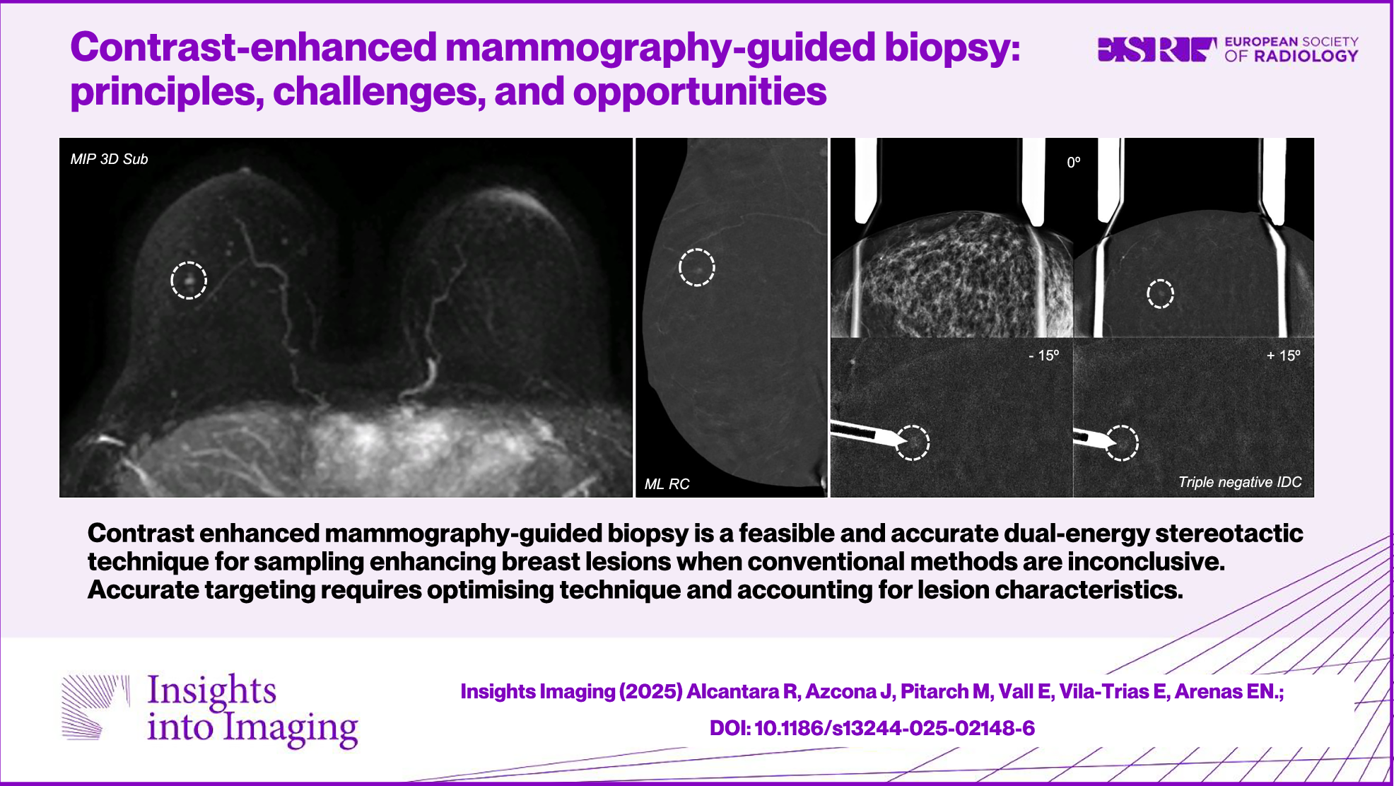 Mammography | Contrast-enhanced mammography-guided biopsy: principles ...