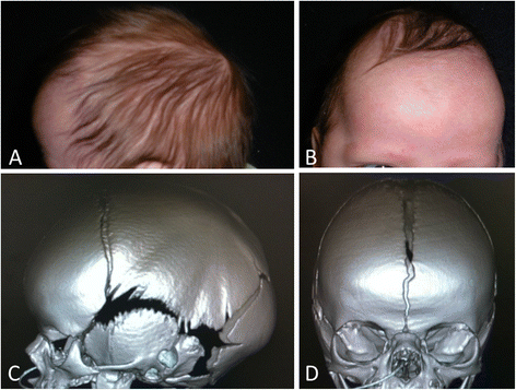Pancraniosynostosis following endoscopic-assisted strip craniectomy for ...
