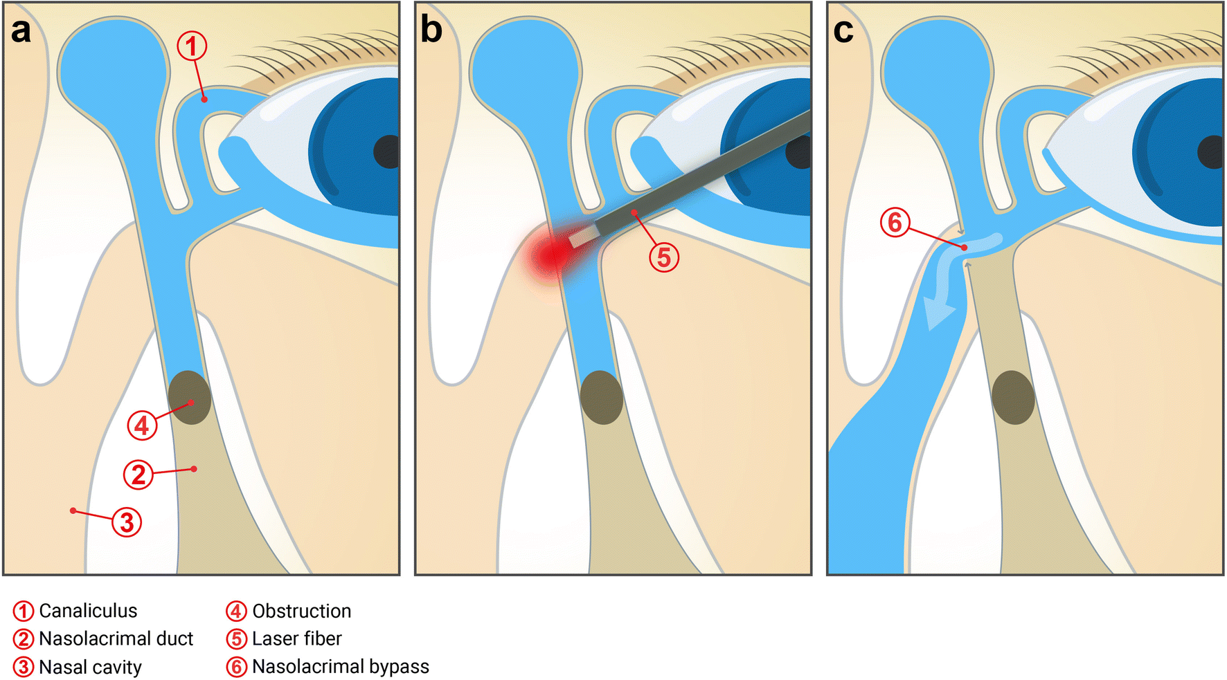 Transcanalicular laser dacryocystorhinostomy for acquired nasolacrimal ...
